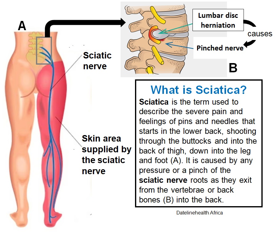 Sciatica Explained to Africans: Causes, symptoms and treatment